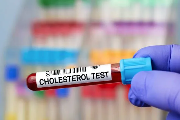 Can You Get a Cholesterol Test at Urgent Care? - UrgiClinic Urgent Care